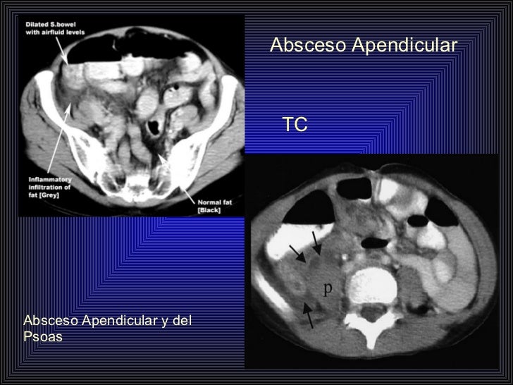 Taller Sobre Apendicitis