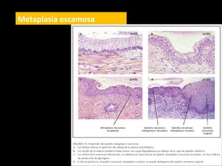 Taller b zona de transformacion metaplasia | PPT