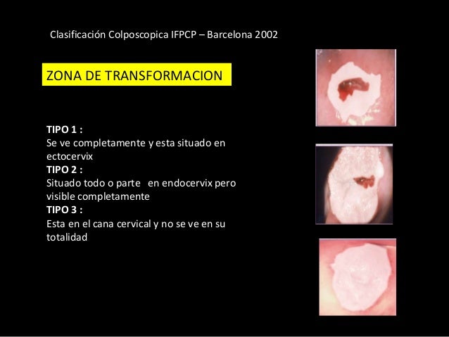 Taller b zona de transformacion metaplasia