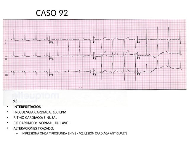 TALLER DE ELECTROCARDIOGRAMA, BASES DEL ANALISIS | PPTX