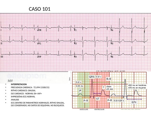 TALLER DE ELECTROCARDIOGRAMA, BASES DEL ANALISIS | PPTX