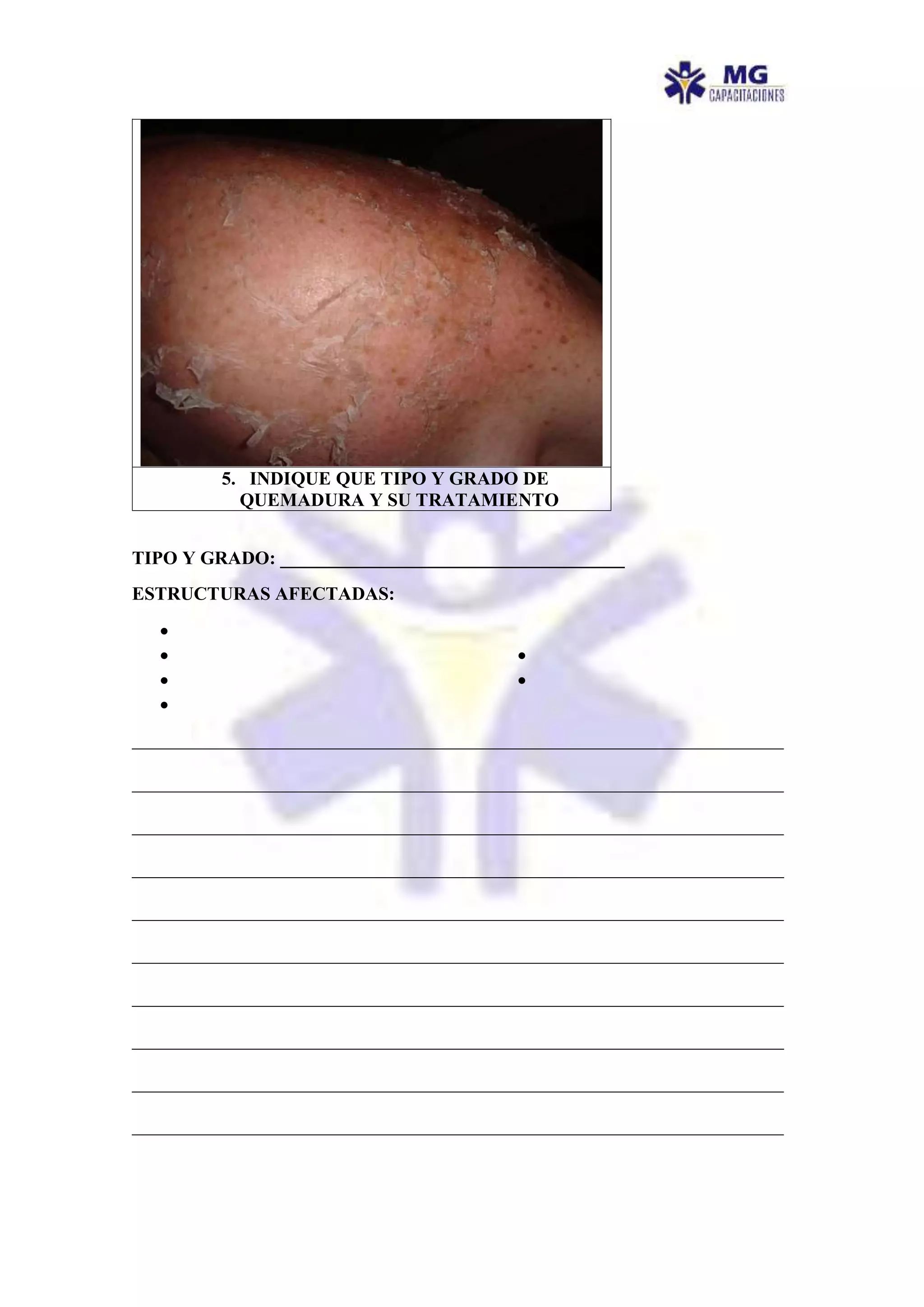 Taller grados de quemaduras y heridas y su tratamiento | PDF