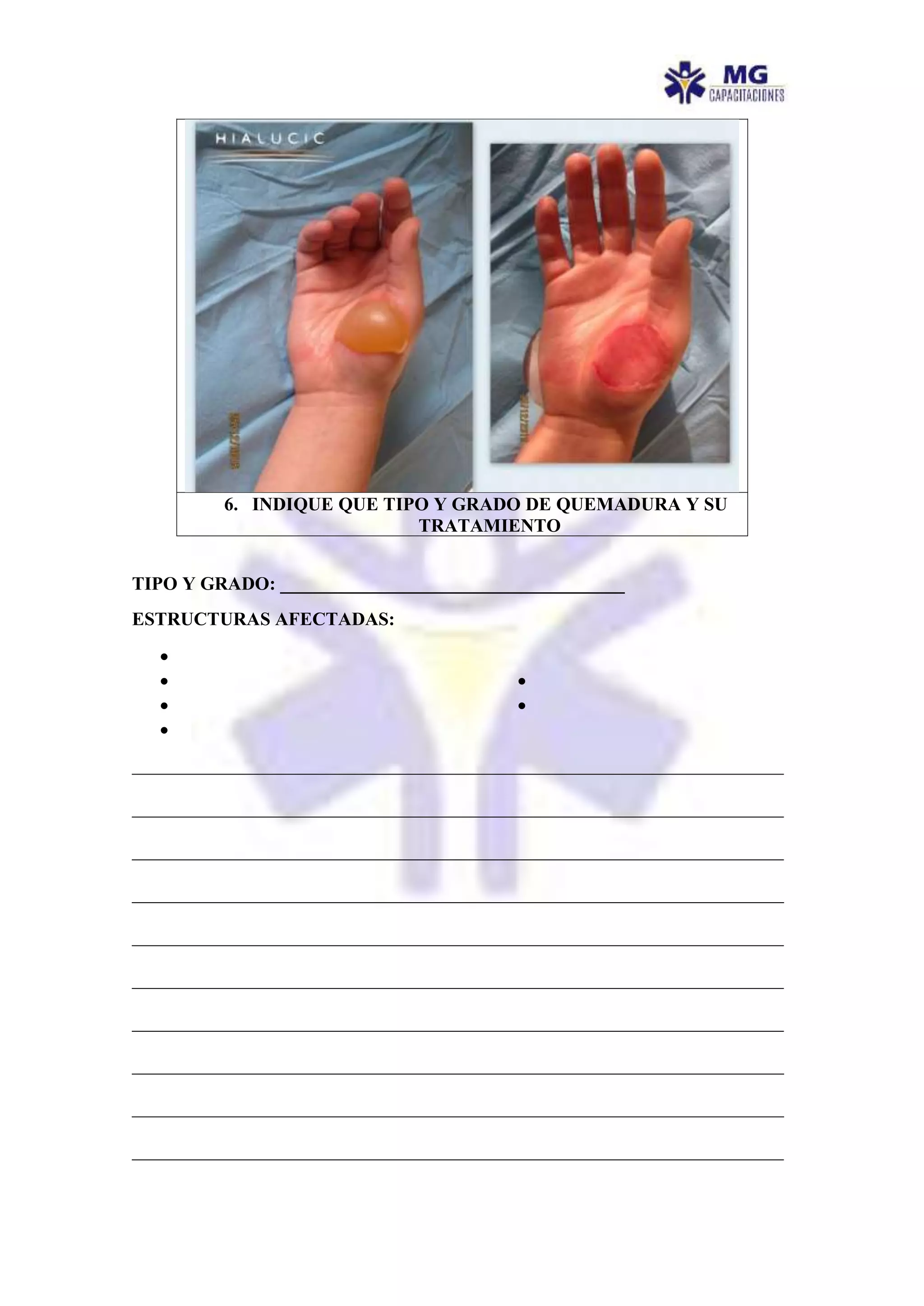 Taller grados de quemaduras y heridas y su tratamiento | PDF