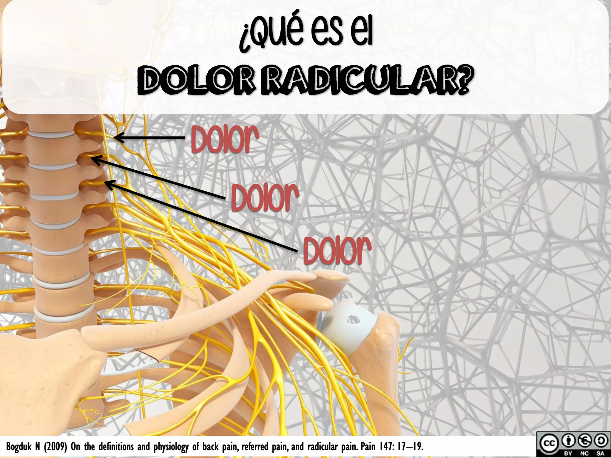 Radiculopatía vs dolor radicular | PDF