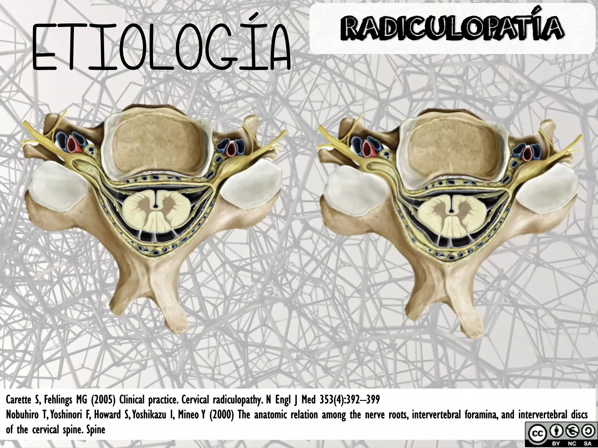 Radiculopatía vs dolor radicular | PDF