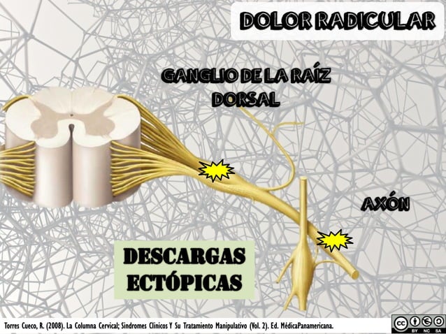 Radiculopatía vs dolor radicular | PDF
