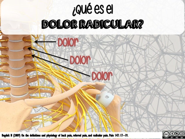 Radiculopatía vs dolor radicular
