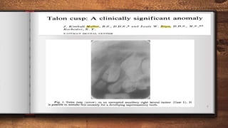 treatment of talon cusp in children | PPTX