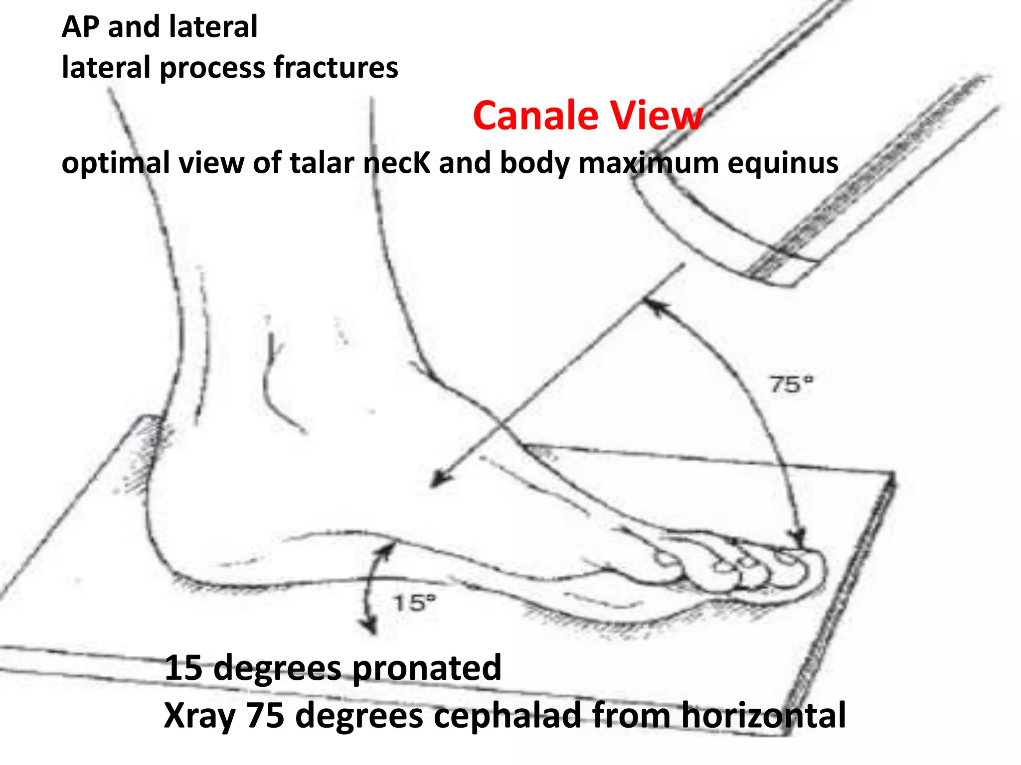 Talus body fracture management | PPT