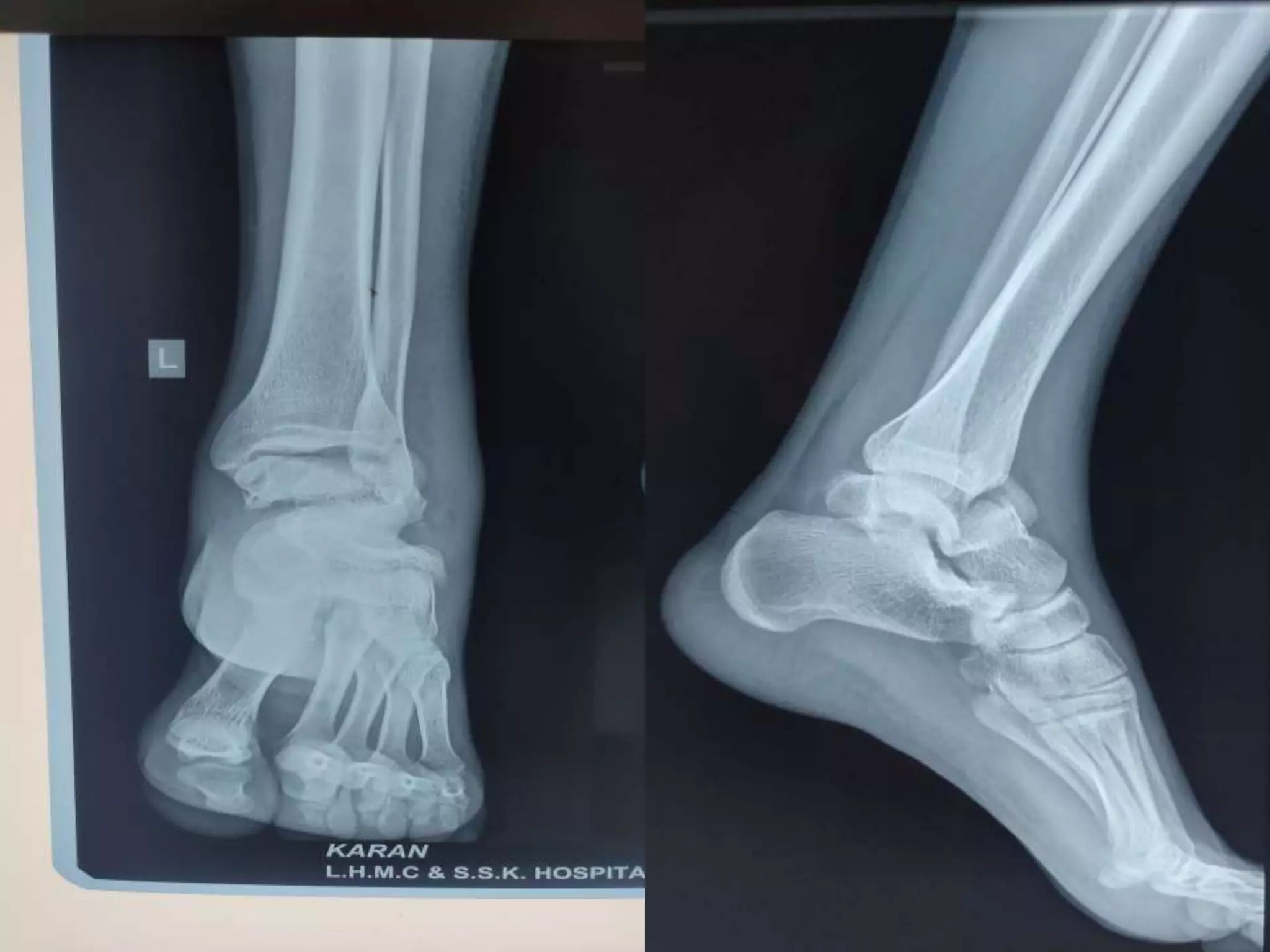 Talus body fracture management | PPT