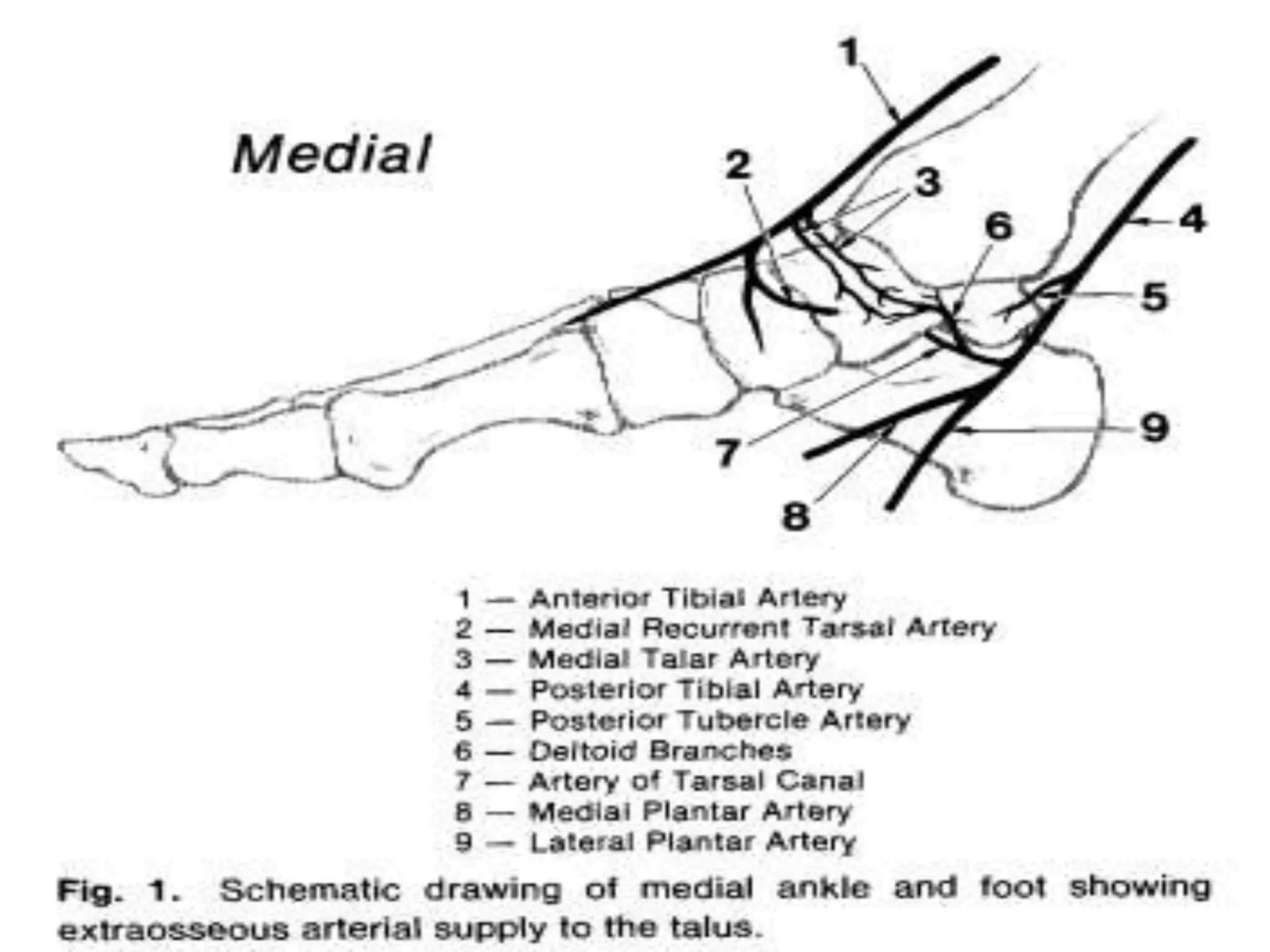 Talus body fracture management | PPT