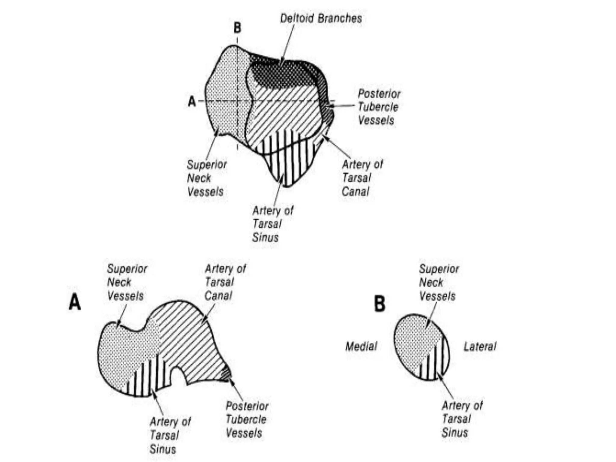 Talus body fracture management | PPT