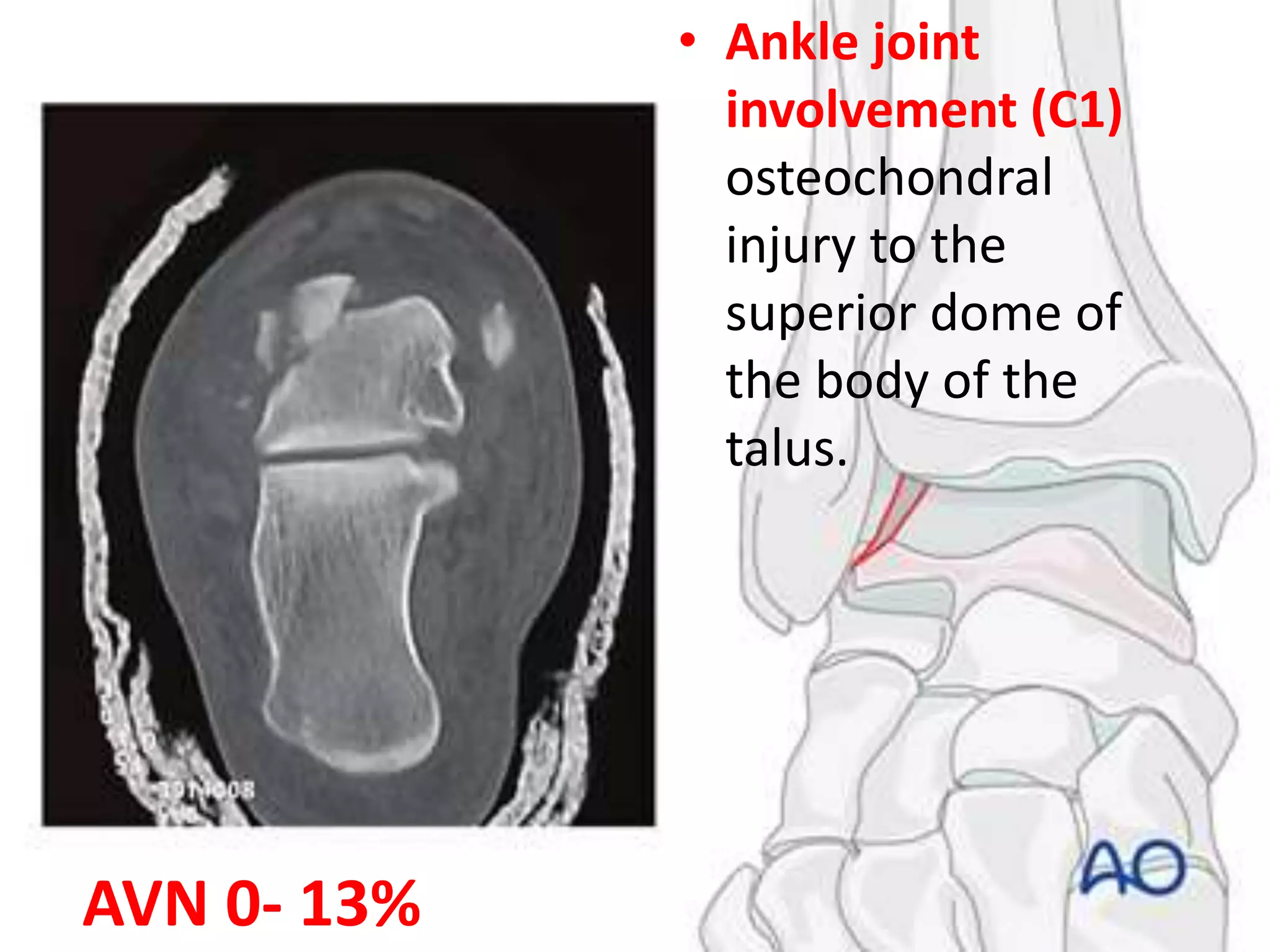Talus body fracture management | PPT