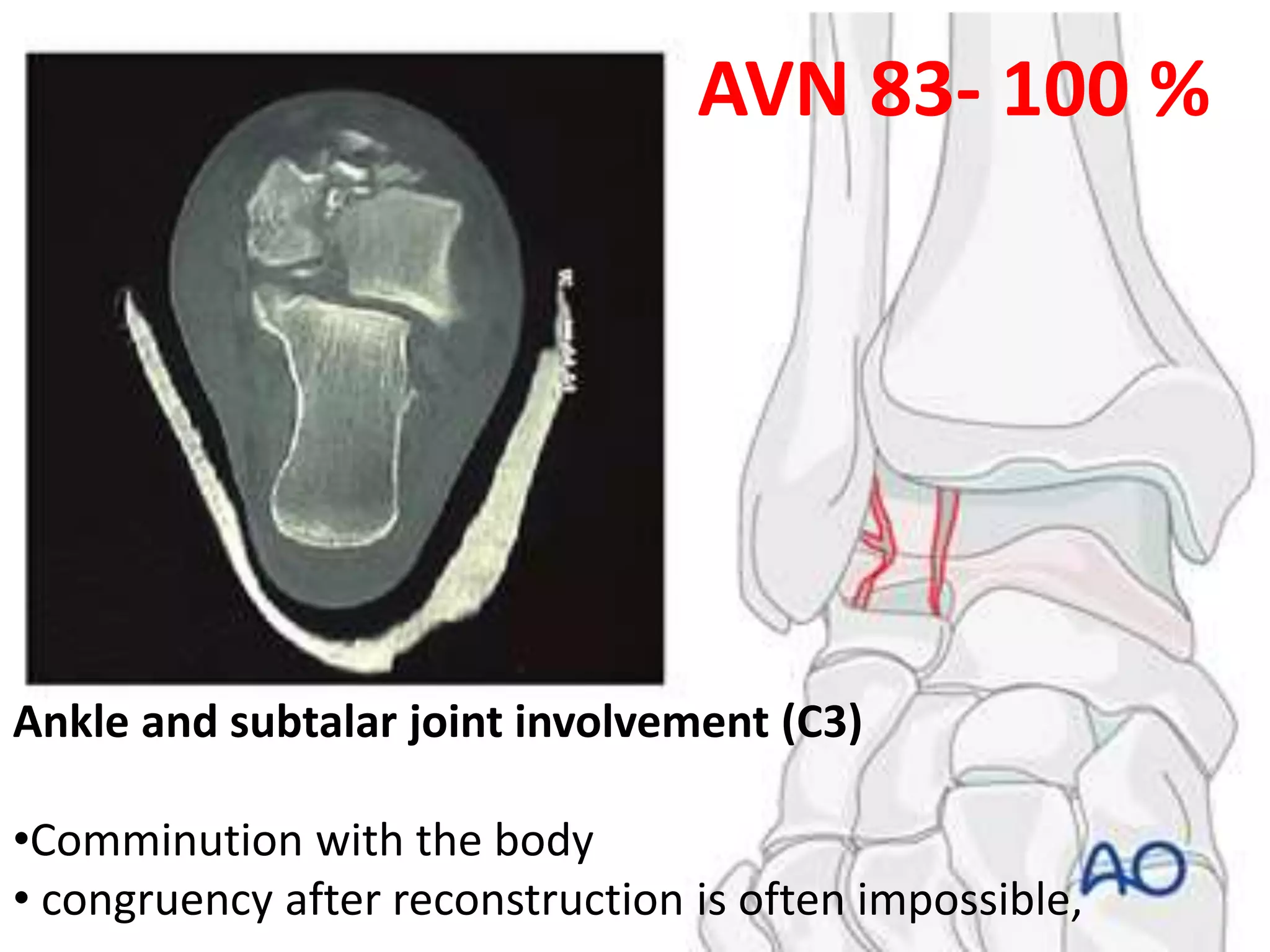 Talus body fracture management | PPT