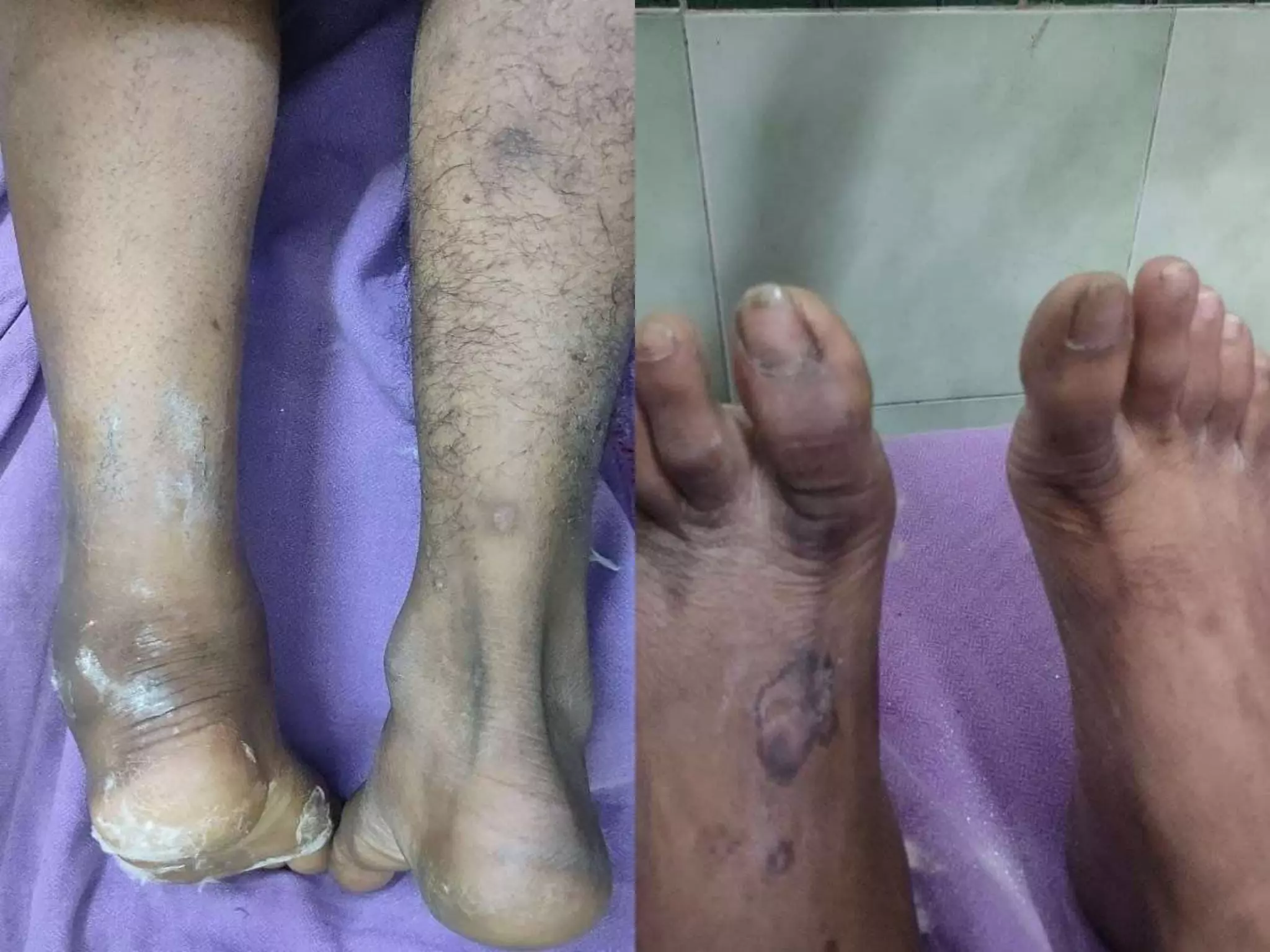 Talus body fracture management | PPT