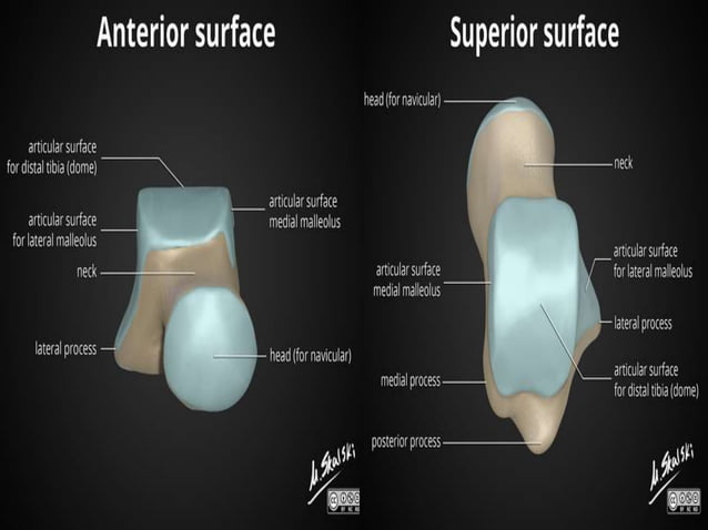Talus body fracture management | PPT