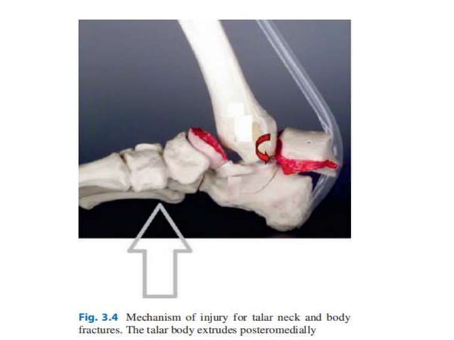 Talus body fracture management | PPT