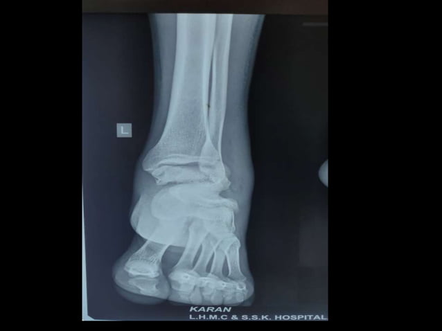 Talus body fracture management | PPT