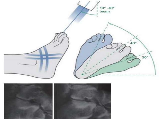 Talus body fracture management | PPT