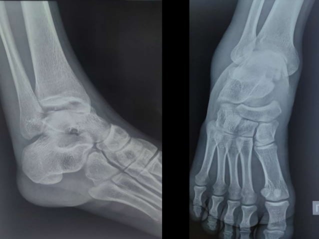 Talus body fracture management | PPT