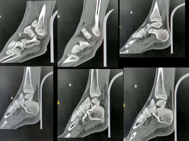Talus body fracture management | PPT