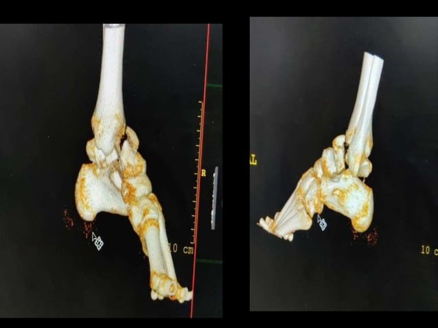 Talus body fracture management | PPT