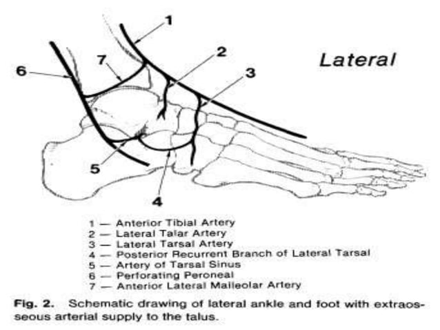 Talus body fracture management | PPT
