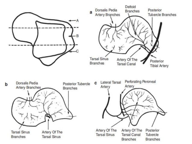 Talus body fracture management | PPT