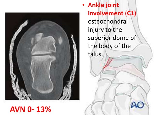 Talus body fracture management | PPT