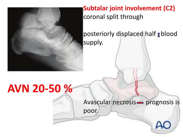 Talus body fracture management | PPT