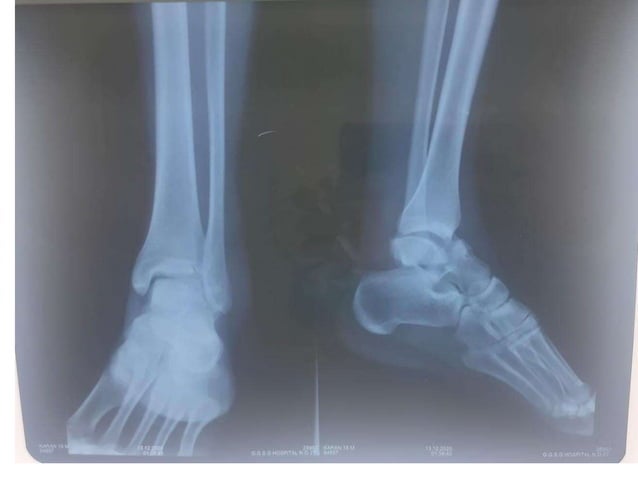 Talus body fracture management | PPT