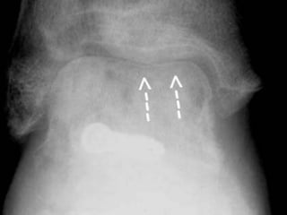 Talus body fracture management | PPT