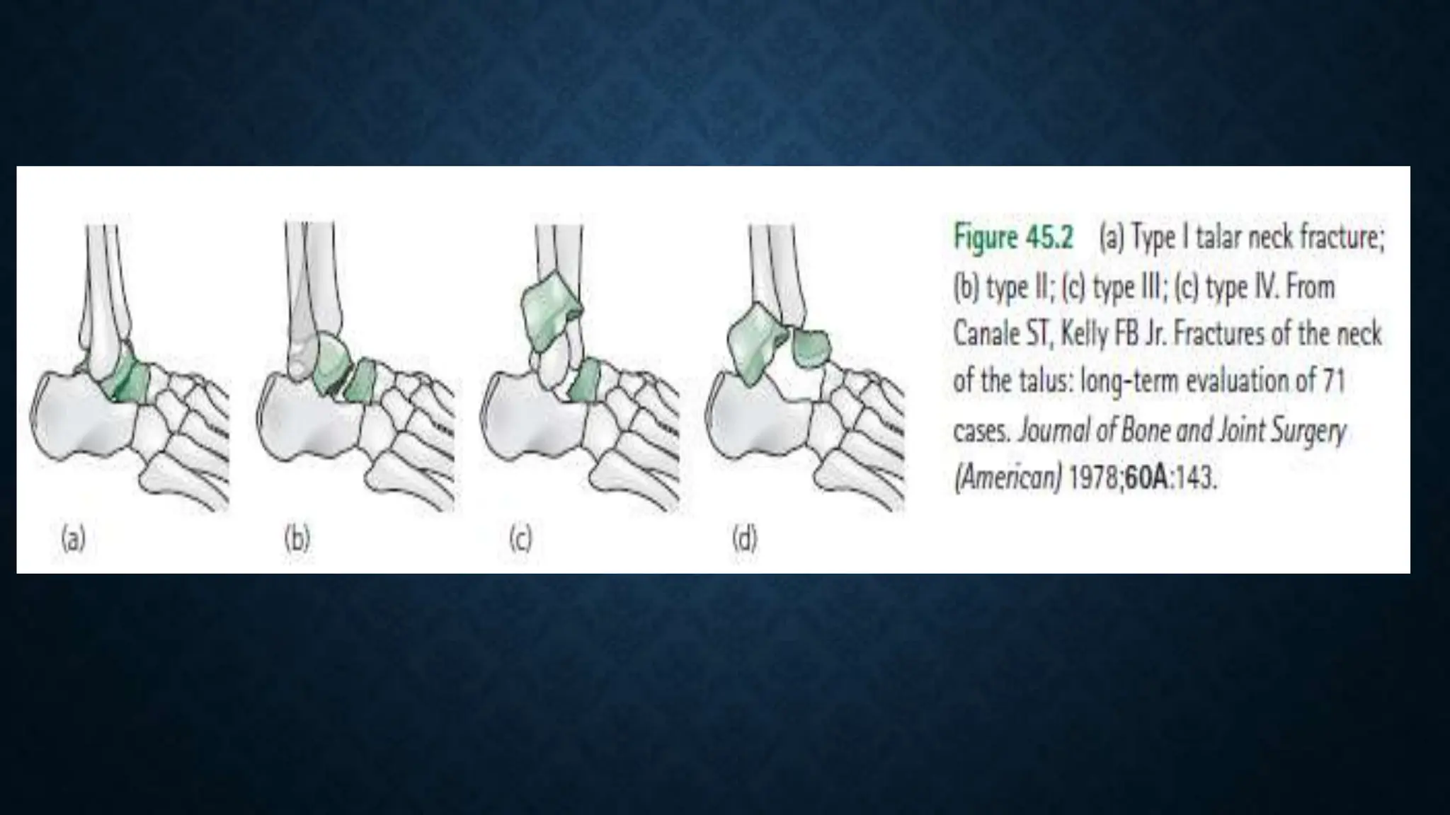 Talus neck fracture of Ankle in leg injuries.pptx