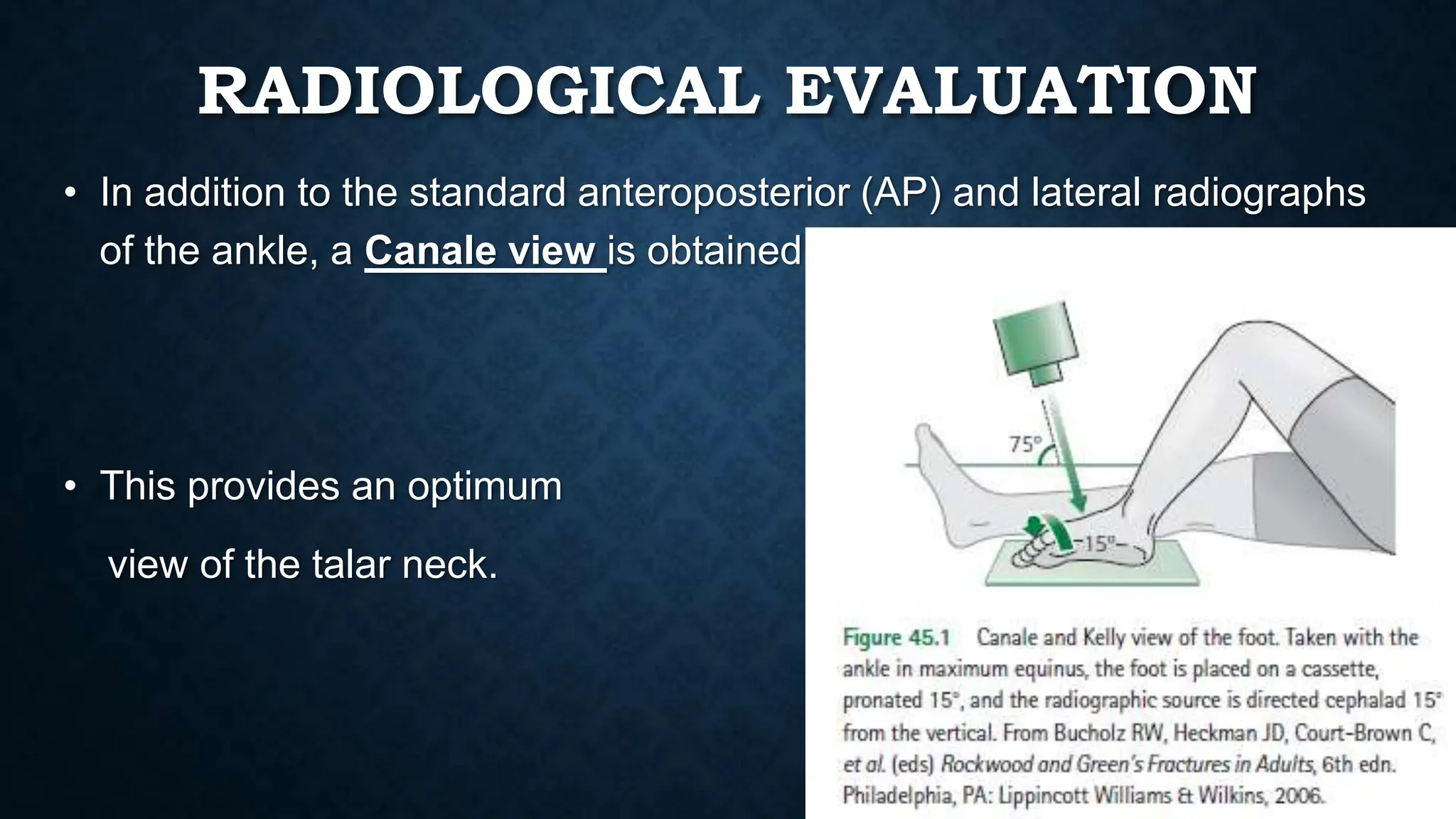Talus neck fracture of Ankle in leg injuries.pptx