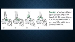 Talus neck fracture of Ankle in leg injuries.pptx
