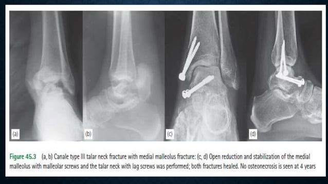 Talus neck fracture of Ankle in leg injuries.pptx