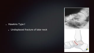 Talus fractures and mx | PPTX