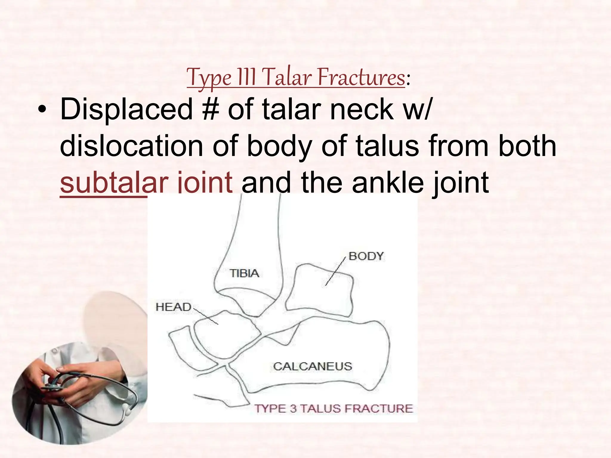 TALUS FRACTURES Classified clinical features and management | PPT