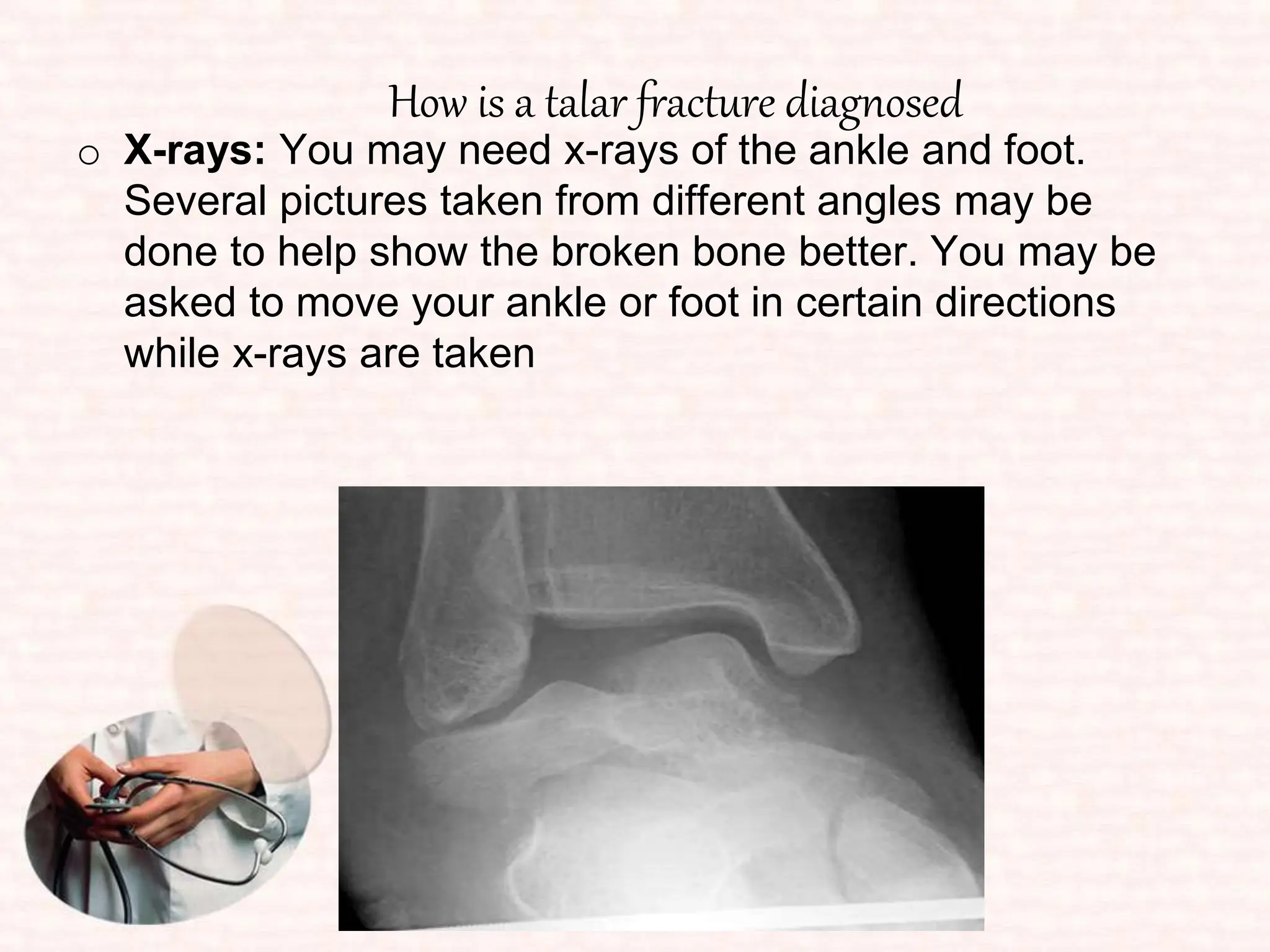 TALUS FRACTURES Classified clinical features and management | PPT
