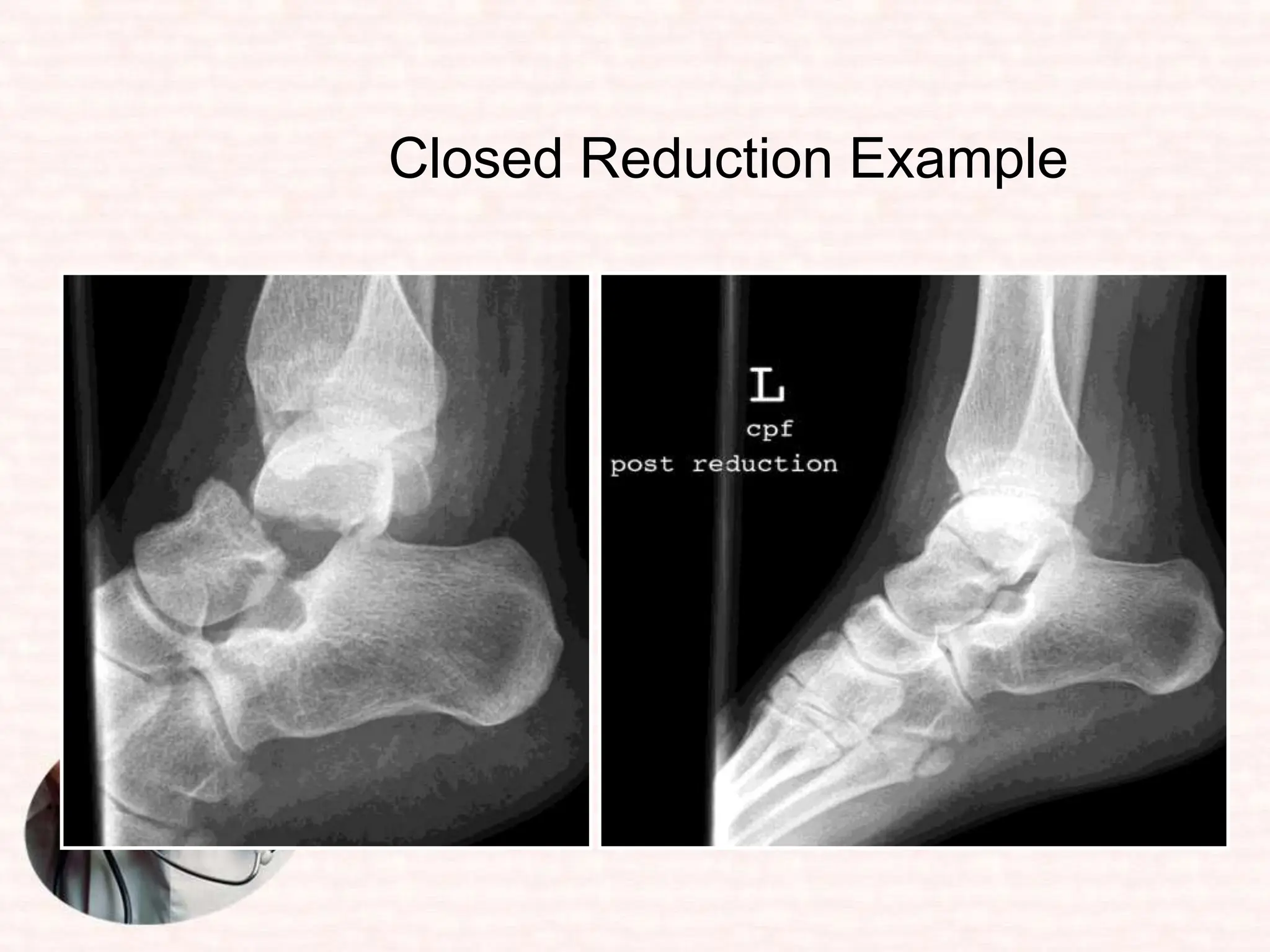 TALUS FRACTURES Classified clinical features and management | PPT