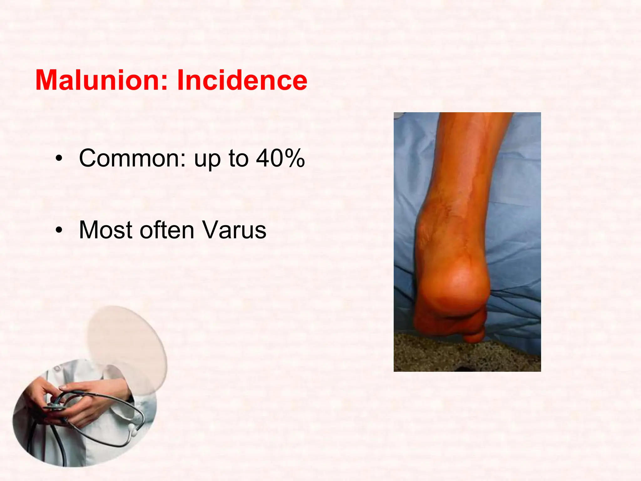 TALUS FRACTURES Classified clinical features and management | PPT