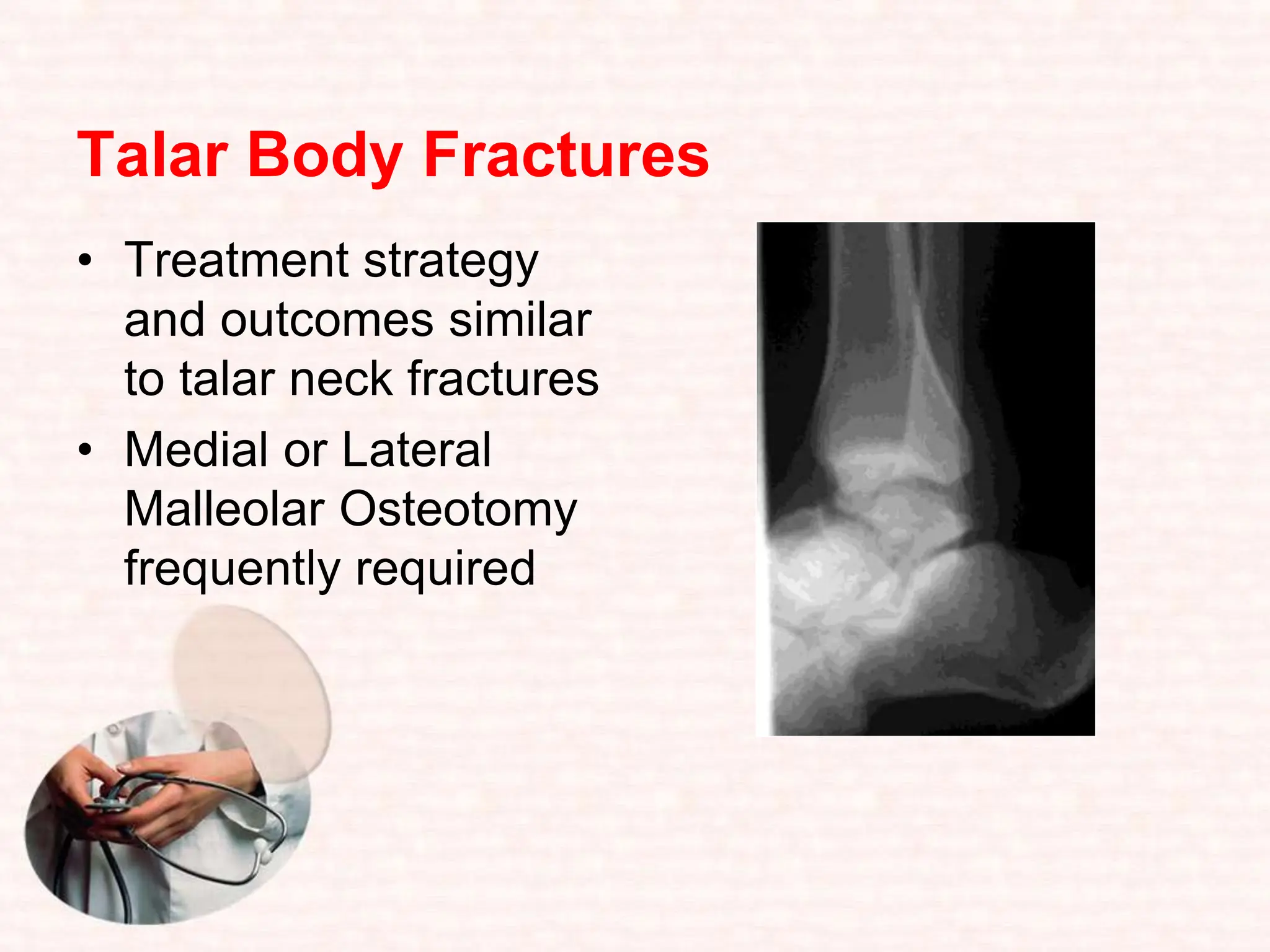 TALUS FRACTURES Classified clinical features and management | PPT