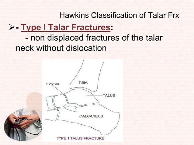 TALUS FRACTURES Classified clinical features and management | PPT