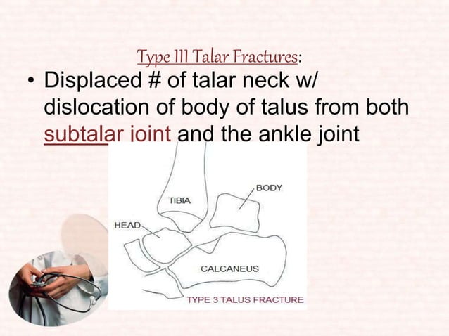 TALUS FRACTURES Classified clinical features and management | PPT