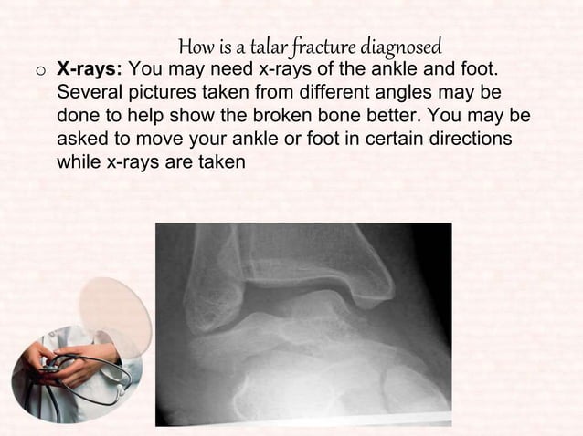 TALUS FRACTURES Classified clinical features and management | PPT