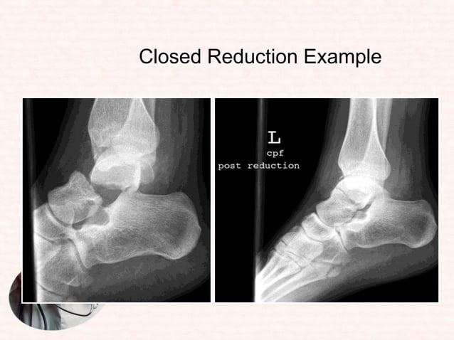 TALUS FRACTURES Classified clinical features and management | PPT