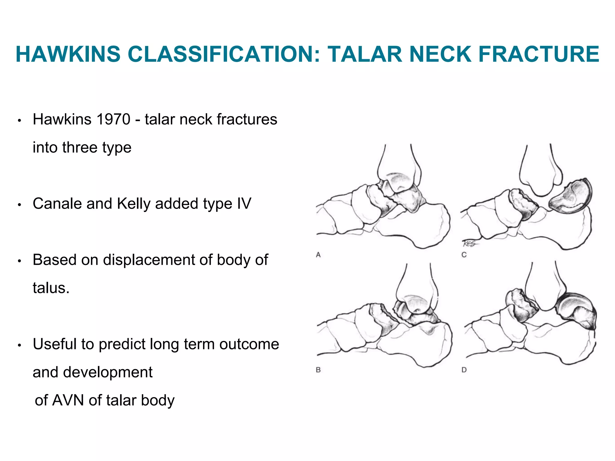 Talus fracture treatment algorithm | PPTX | Death, Injury, or Military ...
