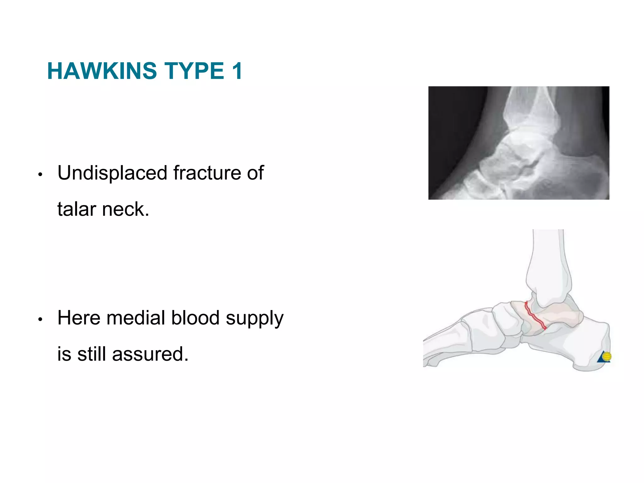 Talus fracture treatment algorithm | PPTX