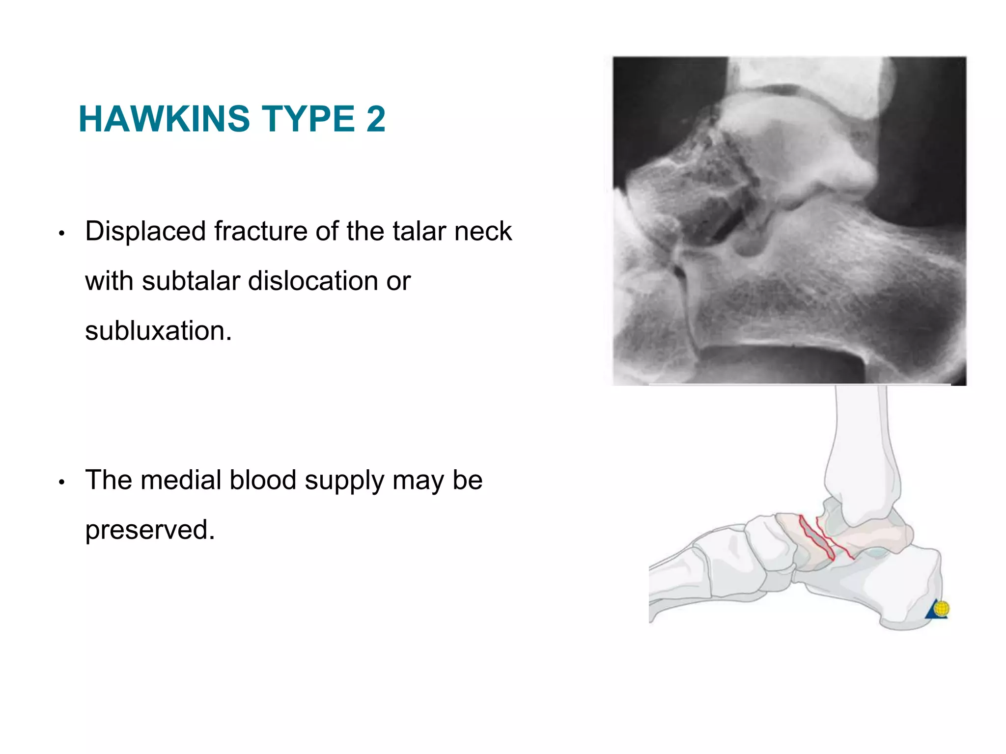 Talus fracture treatment algorithm | PPTX | Death, Injury, or Military ...