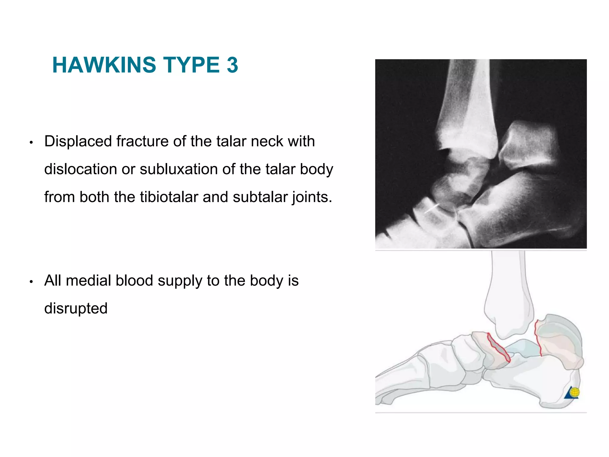 Talus fracture treatment algorithm | PPTX | Death, Injury, or Military ...